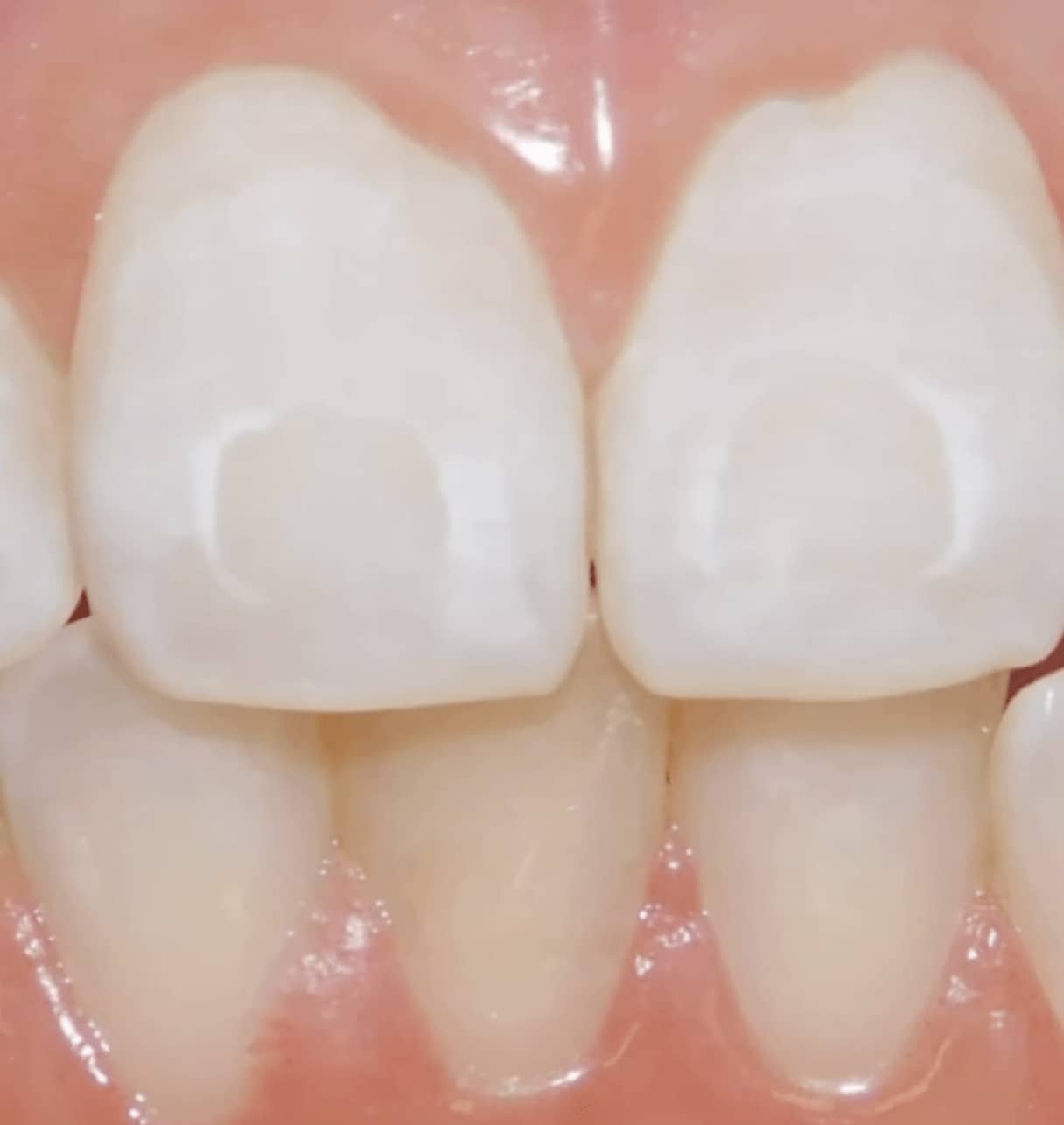 How to Prevent White Spots on Teeth After Braces in Harrisonburg